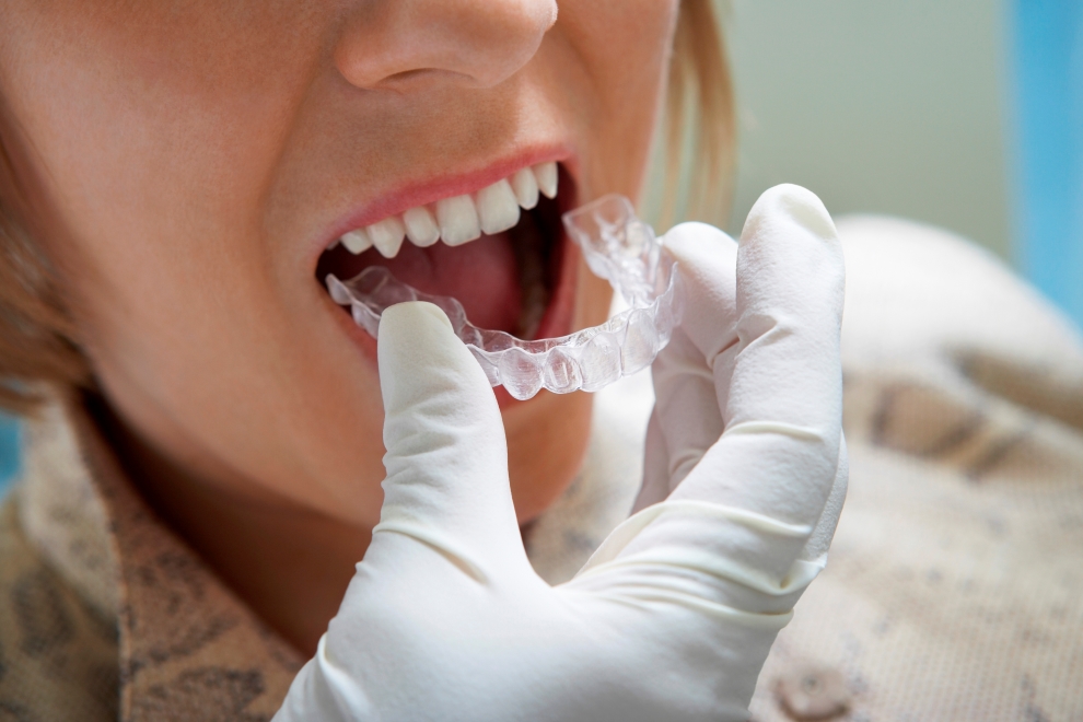 Retenedores en ortodoncia