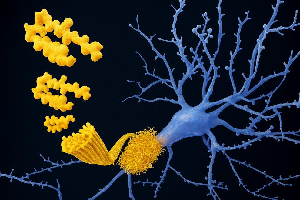 Proteína beta amiloide: clave en el Alzheimer - Sanitas