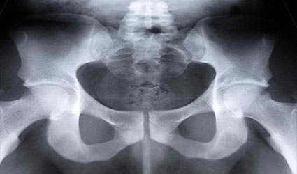 Desgarro del labrum de la cadera