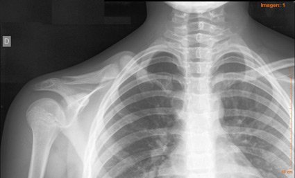 Radiografía De Clavícula Normal