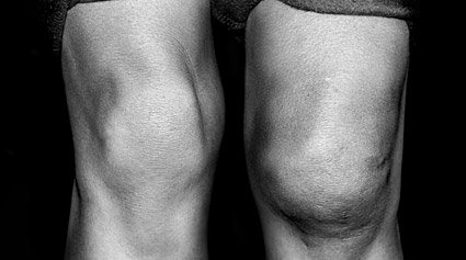 Tratamiento de la tríada